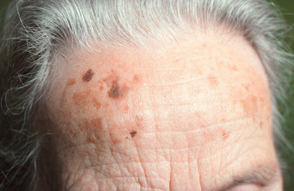 Weißer Hautkrebs - Prof. Dr. med. Eberhard PaulProf. Dr. med. Eberhard Paul